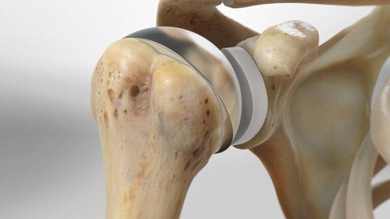 Shoulder Replacement Surgery - Dr. Abhinav Singhal