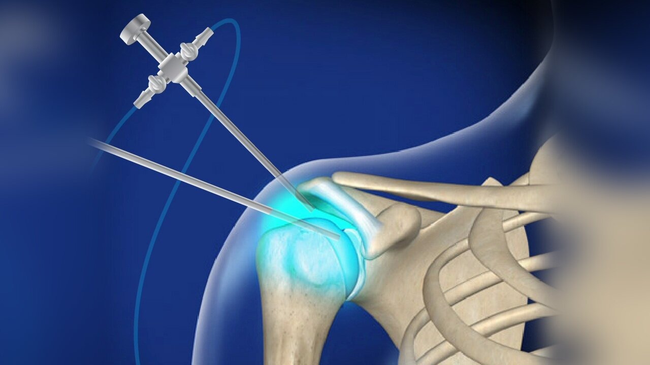 Shoulder Arthroscopy Surgery In Ghaziabad | Dr. Abhinav Singhal