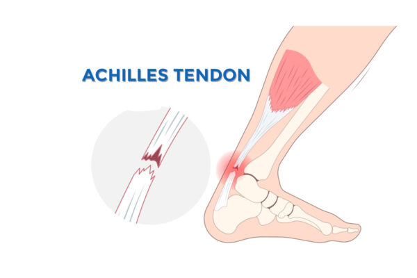 Tendo Achilles Repair Surgery - Dr. Abhinav Singhal