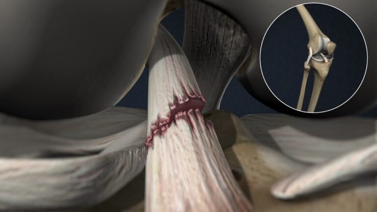 ACL Structure Function Injuries — Expert Orthopaedic Insight