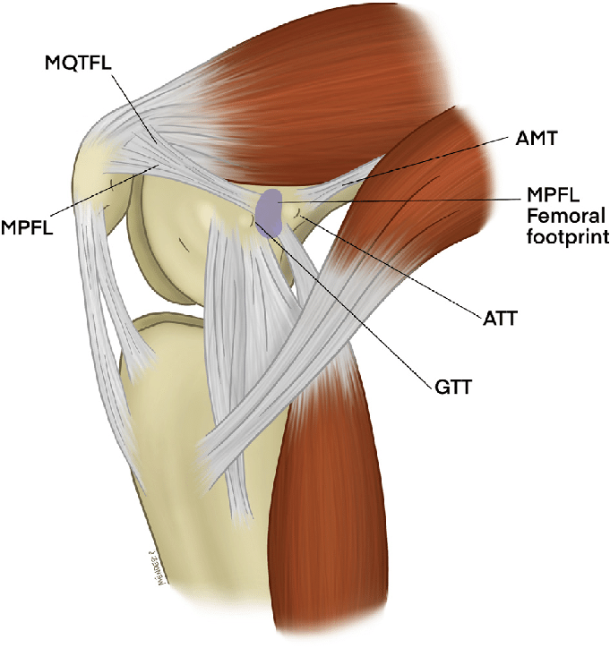 Medial Patellofemoral Ligament (MPFL) - Dr. Abhinav Singhal