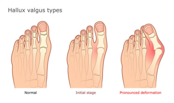 Hallux Valgus Deformity - Dr. Abhinav Singhal