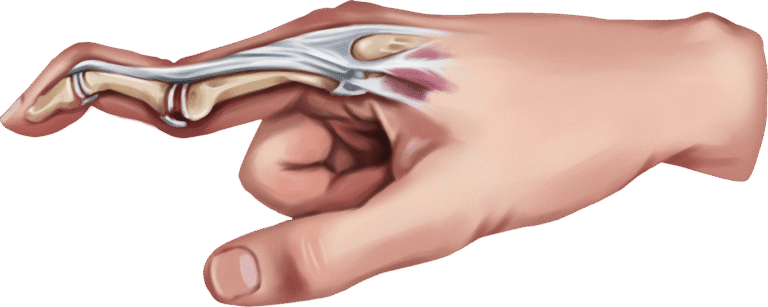 Swan Neck Deformity - Dr. Abhinav Singhal